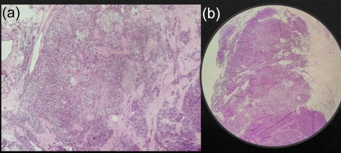 Leydig Cell Tumour Of Ovary In A Postmenopausal Woman A Rare
