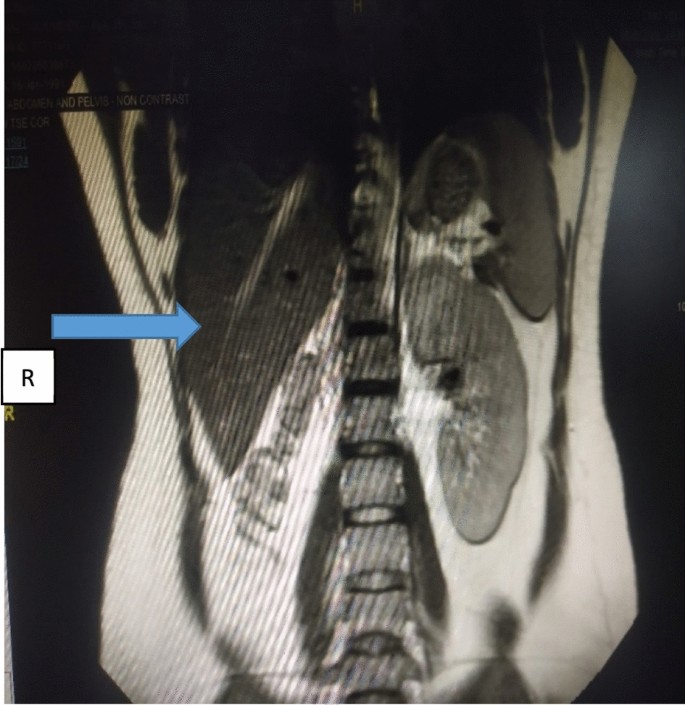 Obstructed Hemivagina and Ipsilateral Renal Agenesis (OHVIRA): The ...