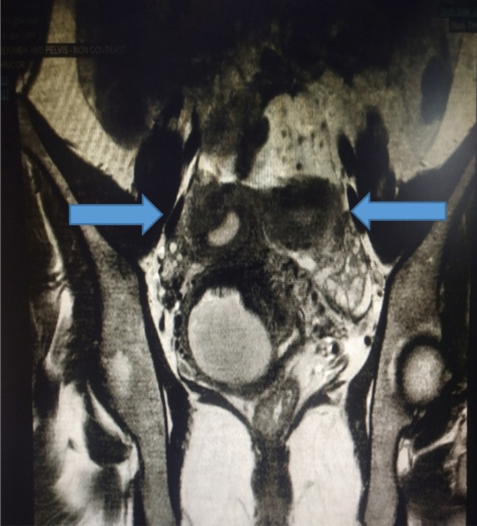 Obstructed Hemivagina and Ipsilateral Renal Agenesis (OHVIRA): The ...