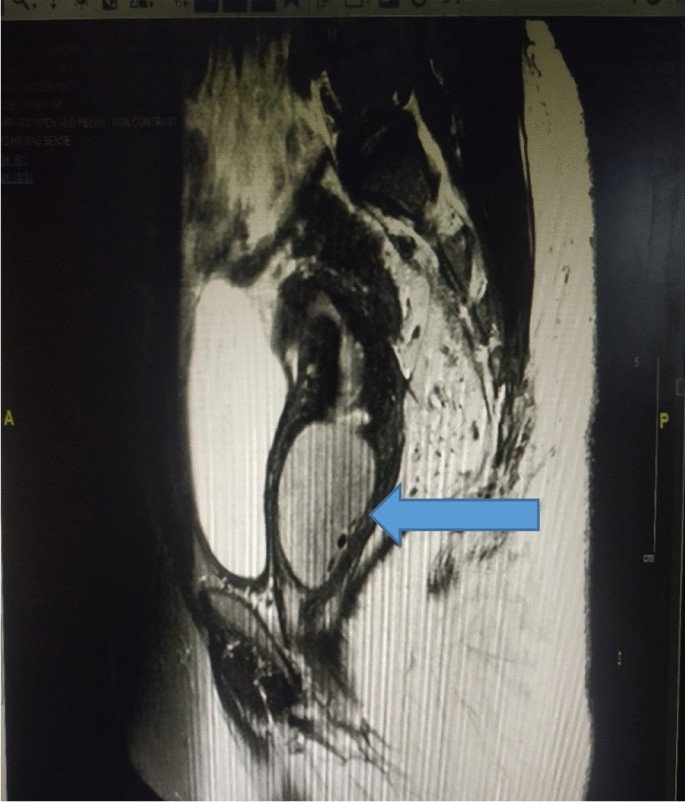 Obstructed Hemivagina and Ipsilateral Renal Agenesis (OHVIRA): The ...