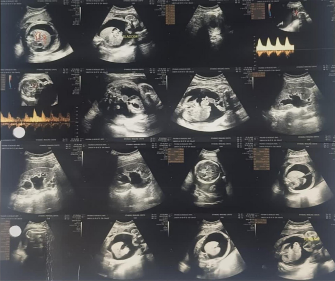 Antenatal Fetal Bladder Rupture: A Rare Catastrophe with Unforeseen ...