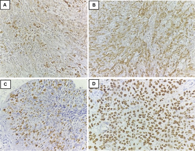 P16, Ki67 and P63 Expression in Cervical Neoplasia: A Diagnostic Bridge ...