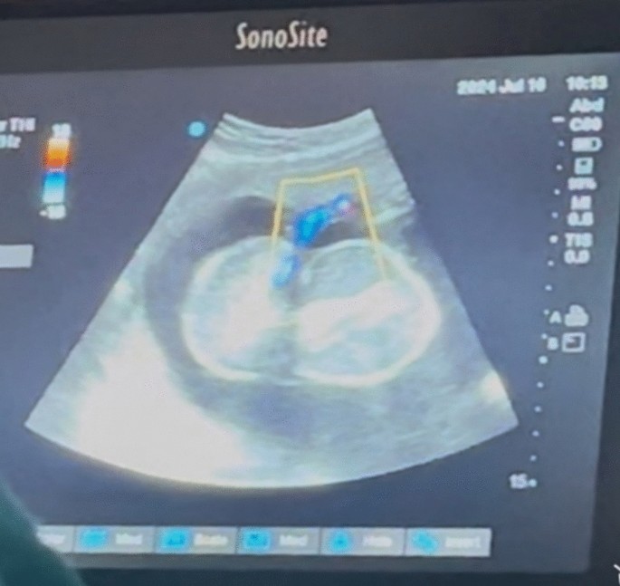 Twin reversed arterial perfusion sequence: managing a rare complication ...