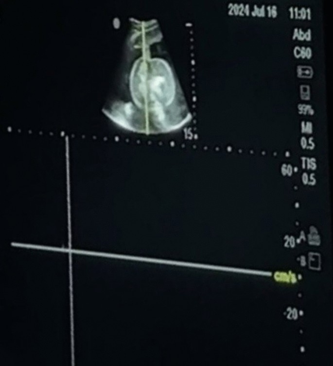 Twin reversed arterial perfusion sequence: managing a rare complication ...