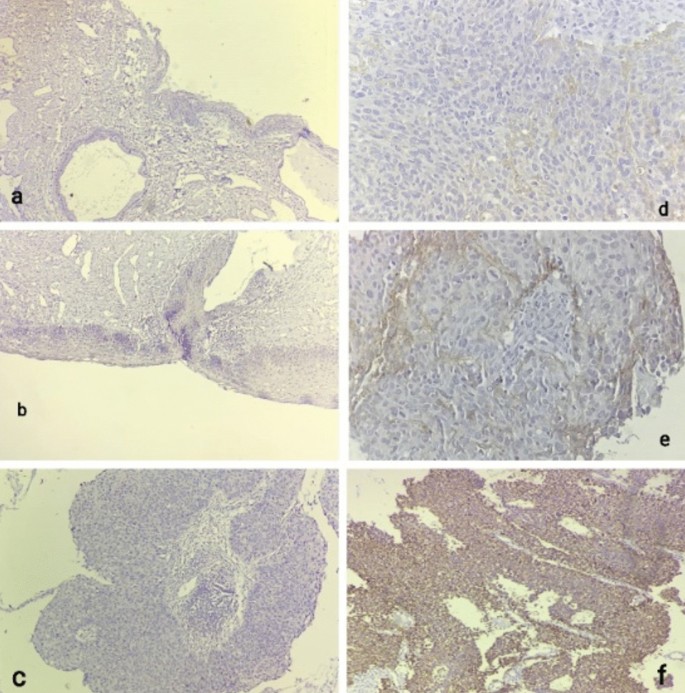 Expression of Her-2/Neu in the Premalignant and Malignant Lesions of ...