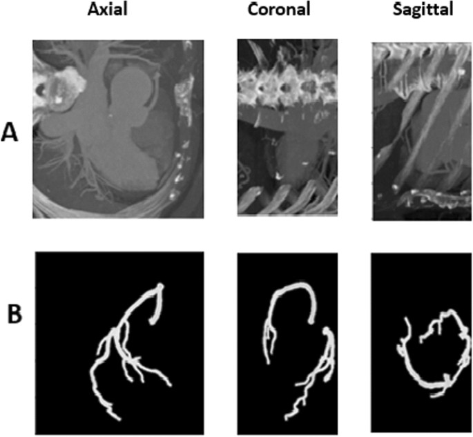 Automated Coronary Artery Segmentation with 3D PSPNET using Global ...