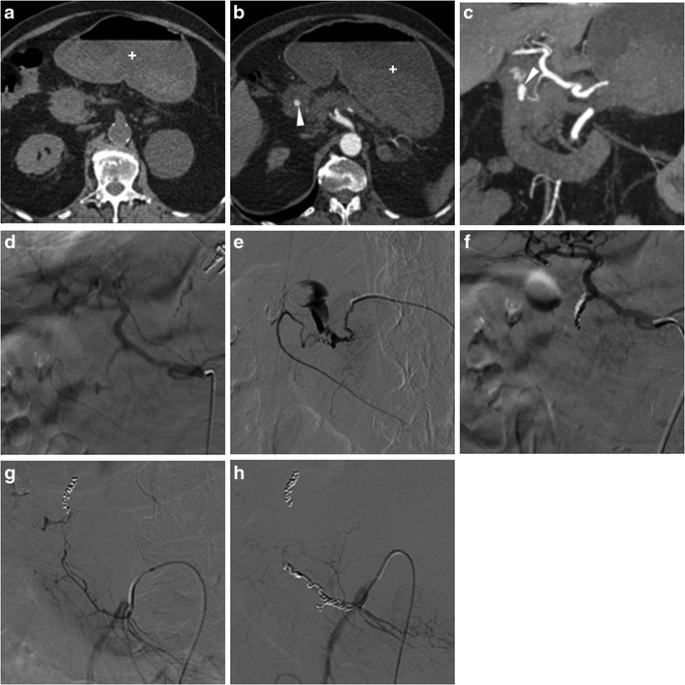 Non perforated Peptic Ulcer Disease Multidetector CT Findings