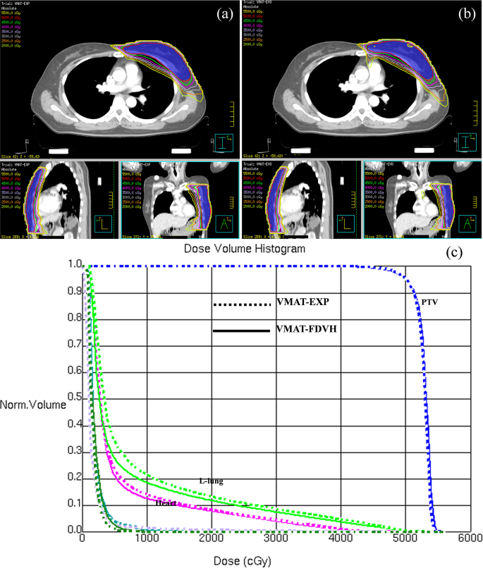Improvement of plan quality in whole-breast radiation following BCS ...