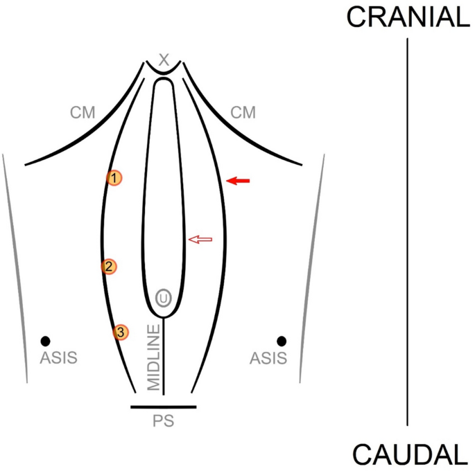 Endoscopic enhanced-view totally extraperitoneal prosthetic (eTEP ...