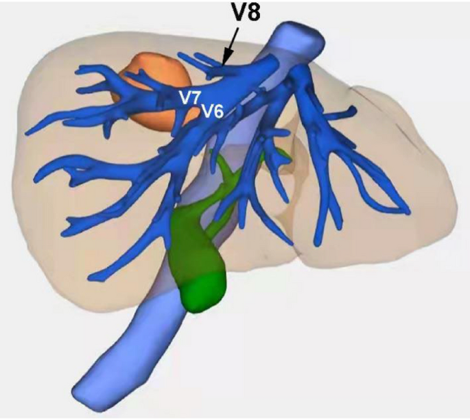 Robotic anatomical resection for hepatocellular carcinoma located ...
