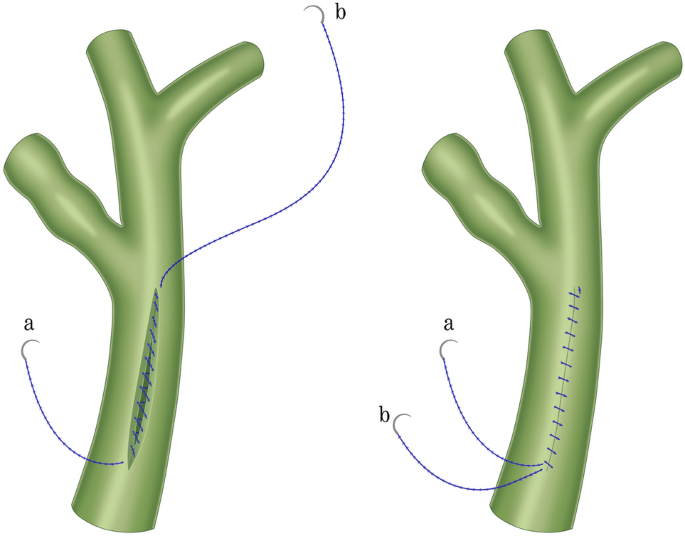 Application of double-needle bi-direction barbed sutures in ...