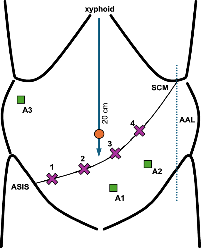Artery first approach in robotic pancreatoduodenectomy: right-sided ...
