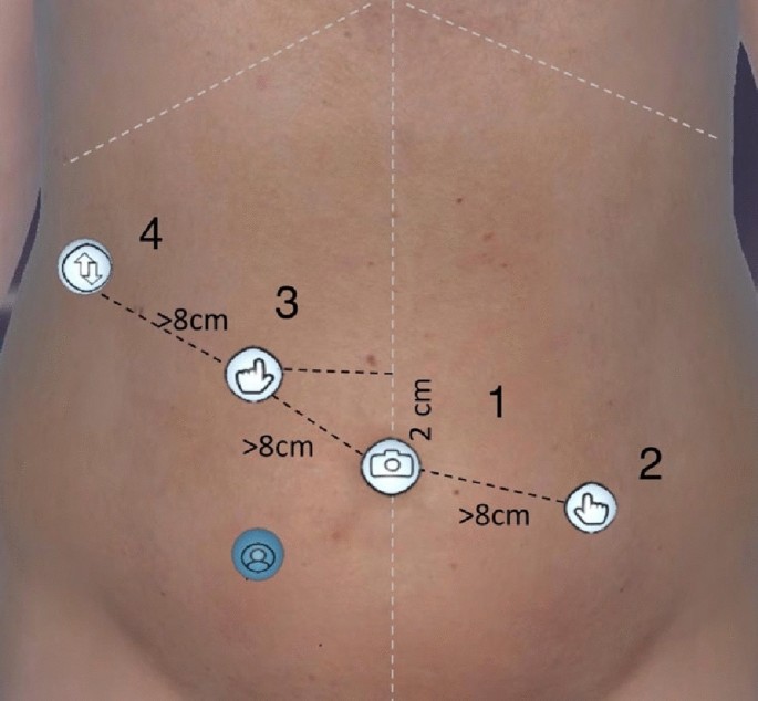 Robotic splenectomy with Hugo-Ras™ system: first worldwide report ...