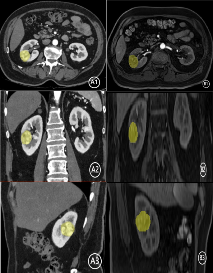 3D holographic reconstruction and intraoperative navigation combined with CBL teaching in ...