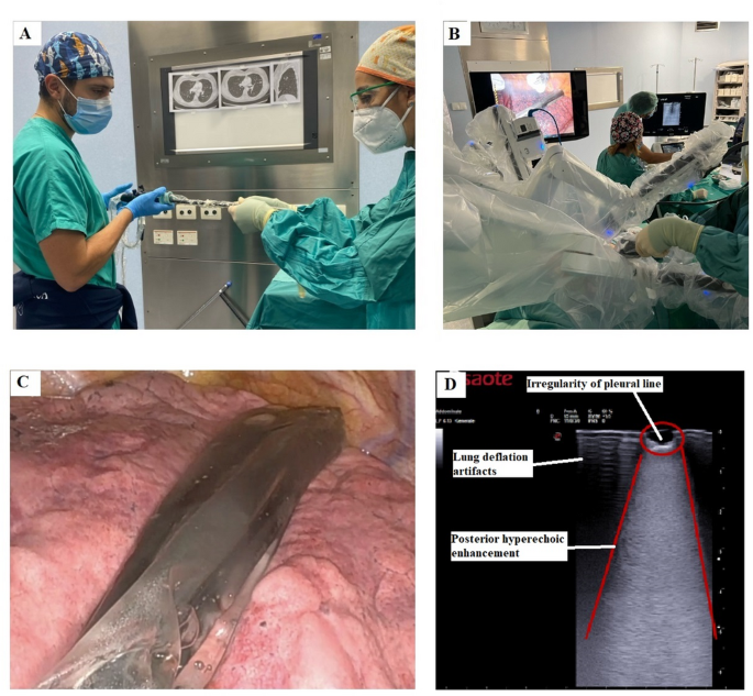 Bridging the sensory gap: intraoperative lung ultrasound for deep ...