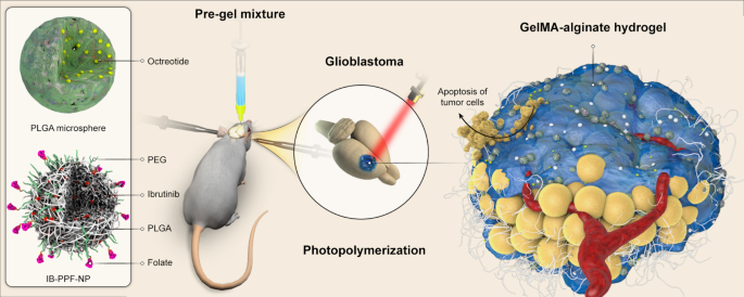 Localized co-delivery of in-situ hydrogel containing ibrutinib-PLGA-PEG ...