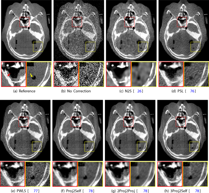 Self-supervised learning for CT image denoising and reconstruction: a review | Biomedical ...