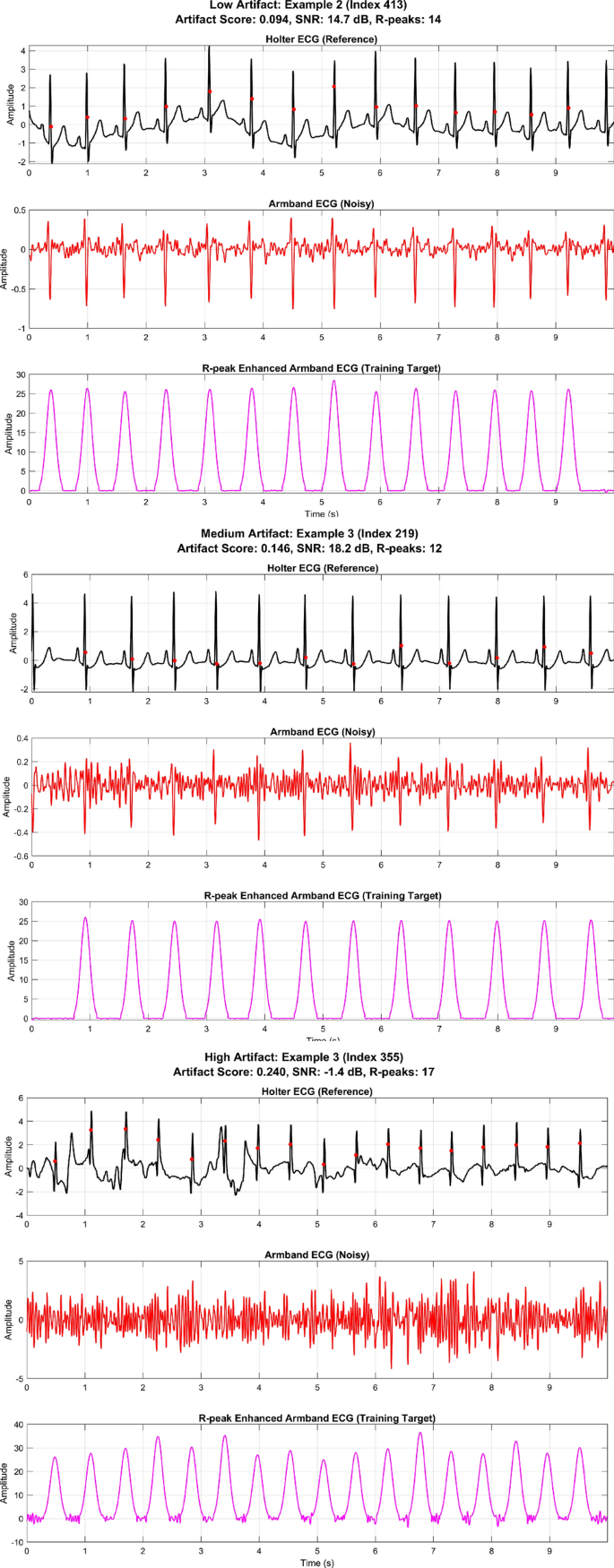 Deep learning for suppressing EMG and motion artifacts in armband ECG R-peak detection ...