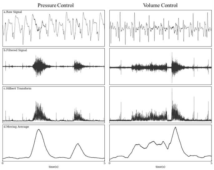 Development of an intraoperative acoustic lung monitoring system for ...