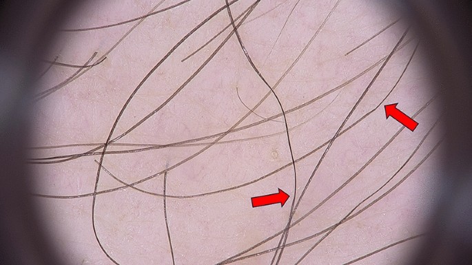 Hair Shaft Abnormalities as a Dermoscopic Feature of Mycosis Fungoides ...