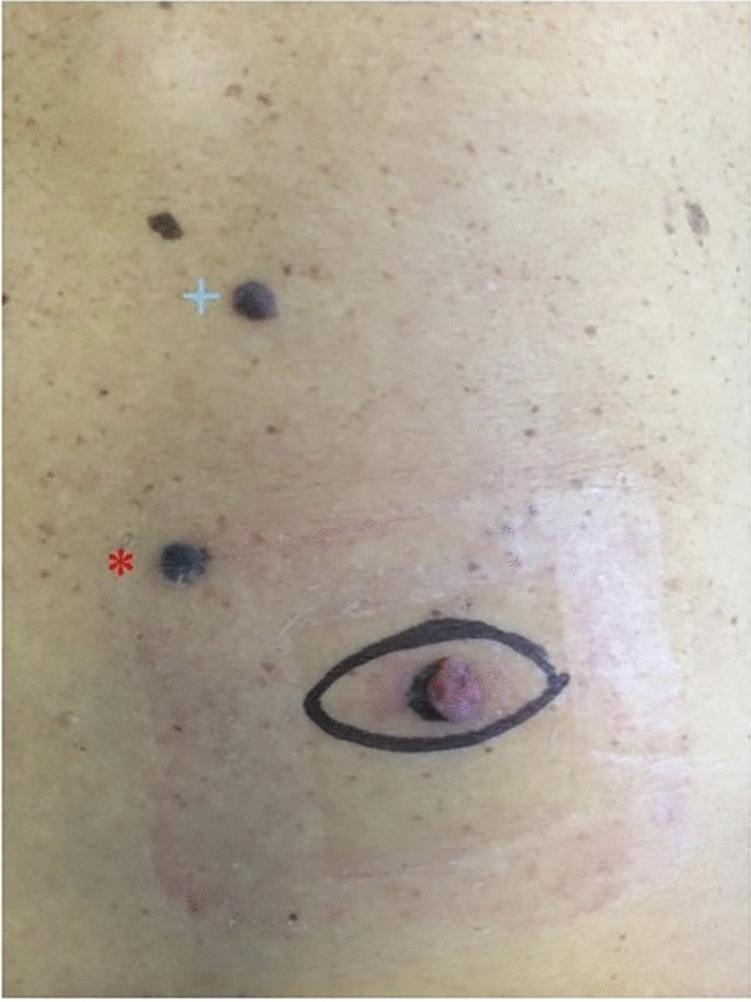 Tumoral Melanosis: A Case Series of a Rare Clinical Entity ...