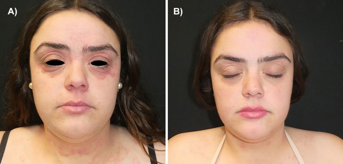 Long-Term Effectiveness, Safety, and Predictive Factors of Tralokinumab ...
