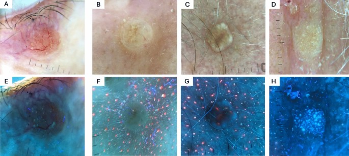 Ultraviolet-Induced Fluorescence Dermoscopy for the Differentiation of ...