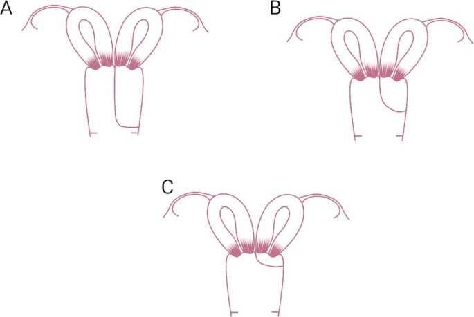 OHVIRA: An In-Depth Review with Practical Applications for OBGYNs ...
