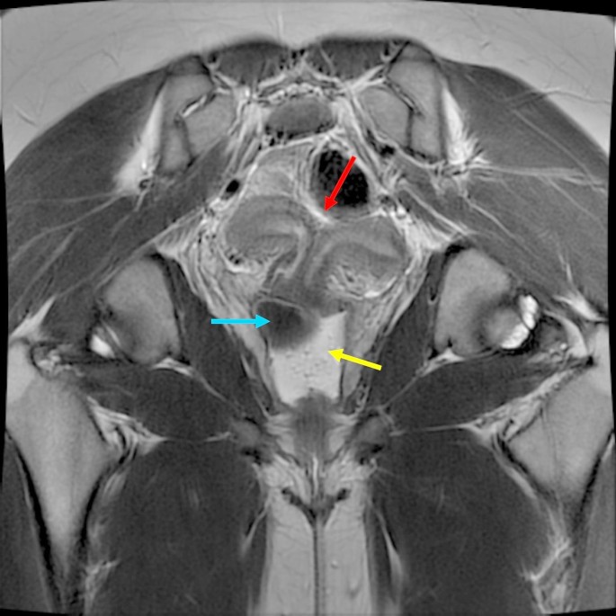OHVIRA: An In-Depth Review with Practical Applications for OBGYNs ...