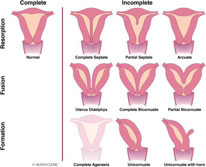 Diagnosis and Classification of Müllerian Anomalies: A Clinical Update ...