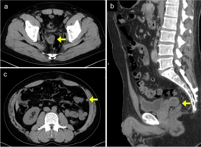 A case of uncommon metastasis located posterior to the seminal vesicles ...
