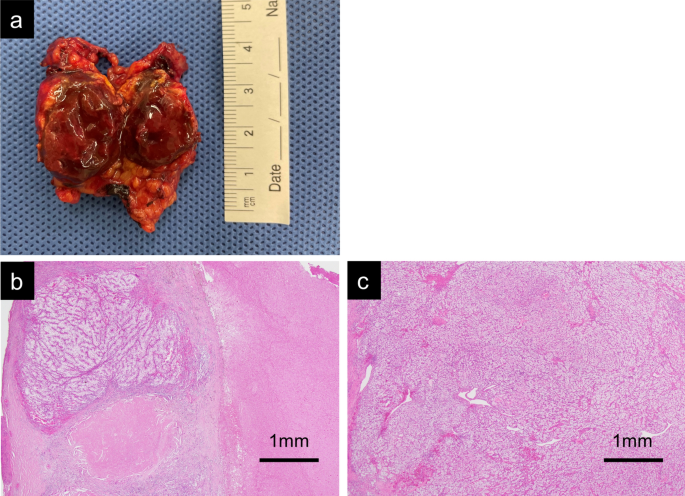 A case of uncommon metastasis located posterior to the seminal vesicles ...