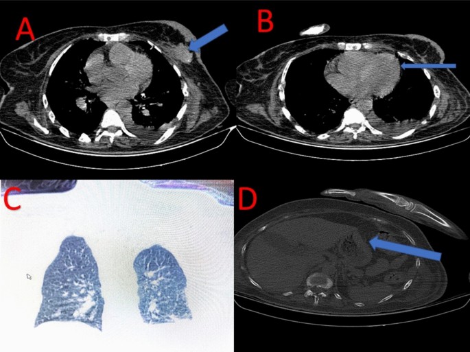 Metastatic calcification due to diffuse lytic skeletal metastases, a ...