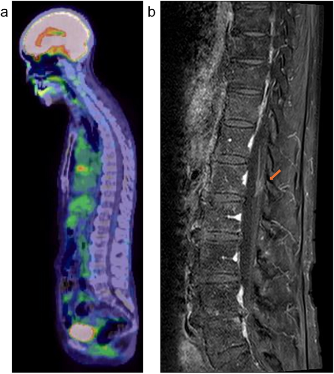Lumbar intramedullary spinal cord metastasis from esophageal cancer ...