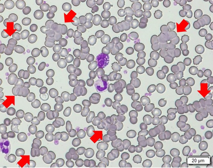 Efficacy of sutimlimab for cold agglutinin disease in a patient on ...
