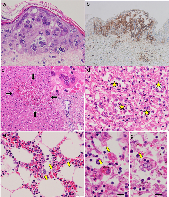 Fatal visceral disseminated varicella zoster virus infection during ...