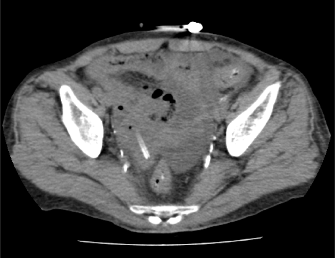 Delayed rectum perforation by a peritoneal dialysis catheter in a peritoneal dialysis patient: a ...