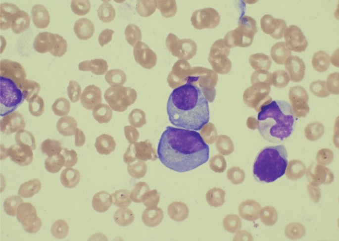 A case of renal infiltration by Bence Jones protein kappa-producing ...