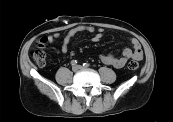 Relapsing peritoneal dialysis‑associated peritonitis caused by ...