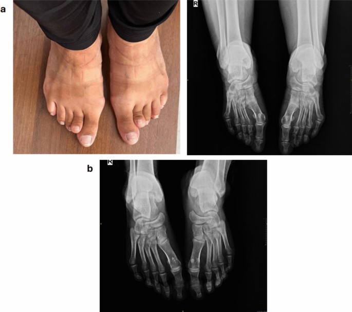 Delayed diagnosis of Townes-Brocks syndrome accompanied with kidney ...