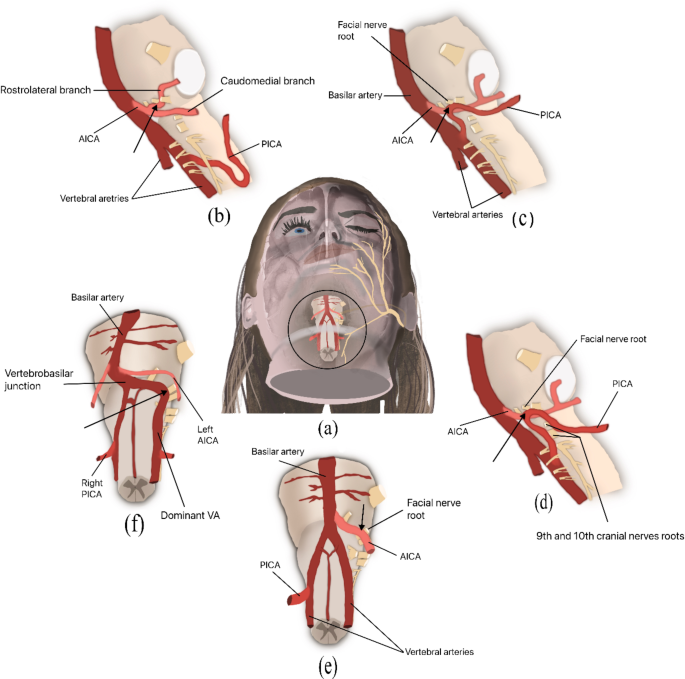 Primary hemifacial spasm: anatomical insights | Acta Neurologica ...