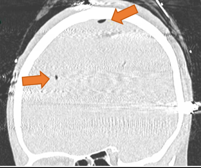 A case of fatal cerebral air embolism in a patient with Osler-Weber ...