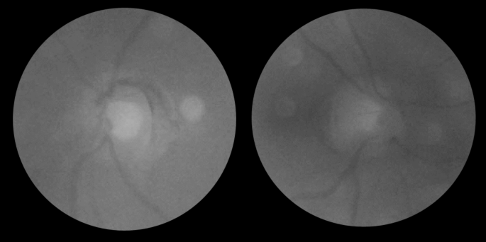 Septo–optic dysplasia with associated closed lip schizencephaly: “SOD ...