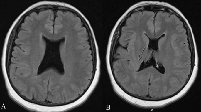 Septo–optic dysplasia with associated closed lip schizencephaly: “SOD ...