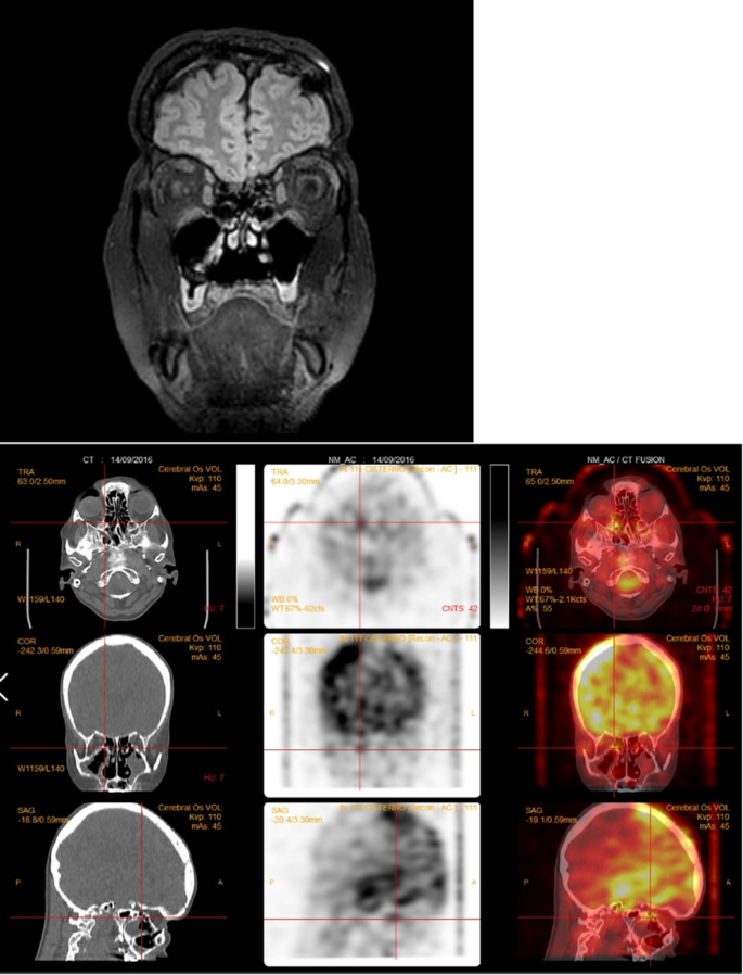 Atypical presentation of a severe form of spontaneous intracranial ...