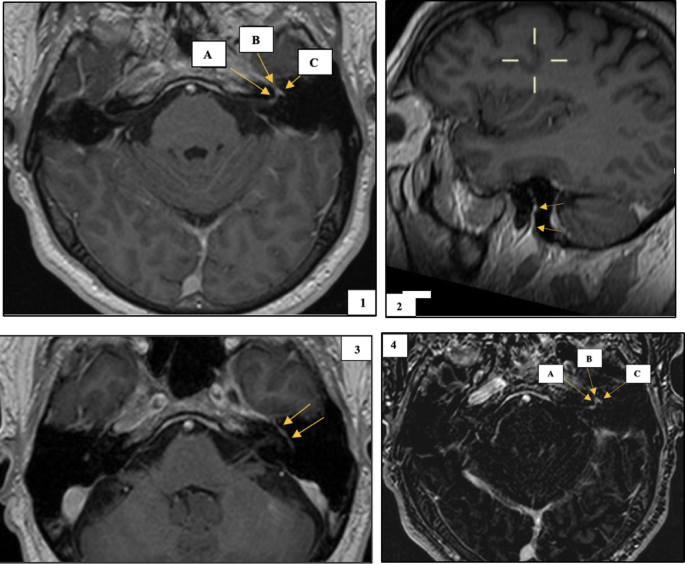 Posterior auricular neuropathy as a complication of facial nerve palsy ...