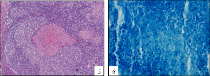 Posterior auricular neuropathy as a complication of facial nerve palsy ...