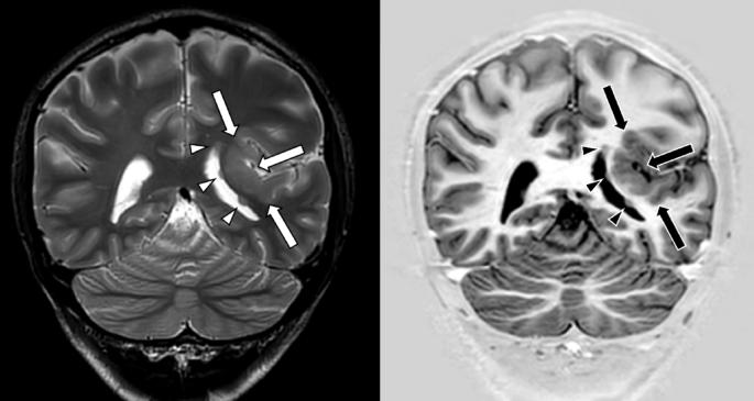 Polymicrogyria with periventricular nodular heterotopia | Acta ...