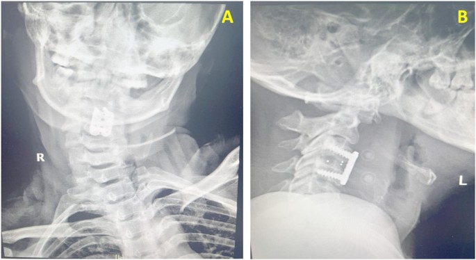 Cervical spondylotic myelopathy caused by cervical dystonia: a case ...