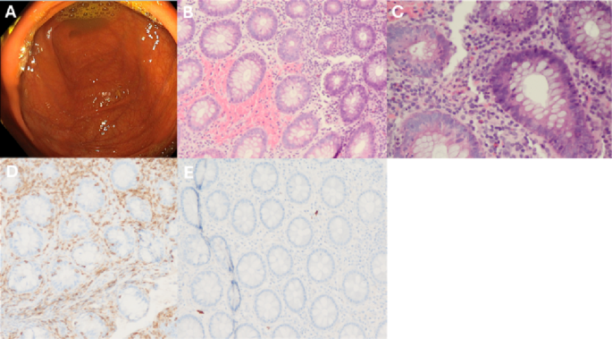 Longstanding histological colitis following ocrelizumab therapy: a case ...